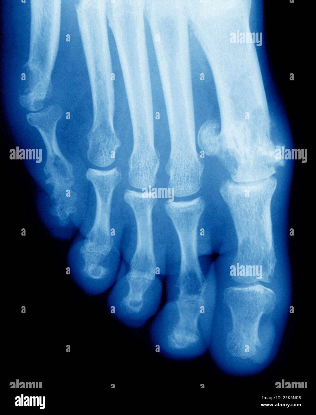 Coloured X-ray of the foot of a patient with gout in the joints of the toes. Gout is a disorder ...