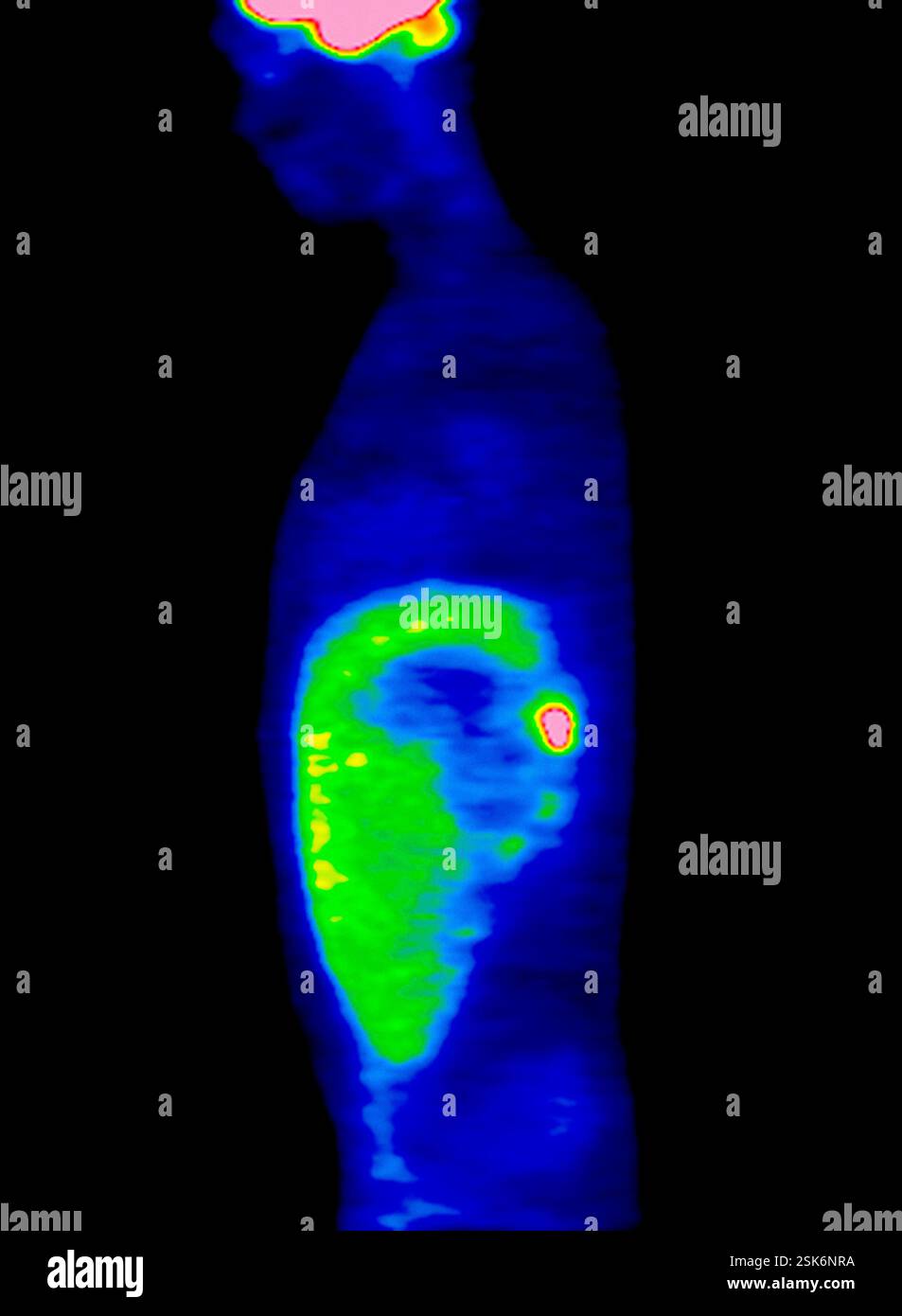 Splenomegaly. Coloured sagittal positron emission tomography (PET) scan ...