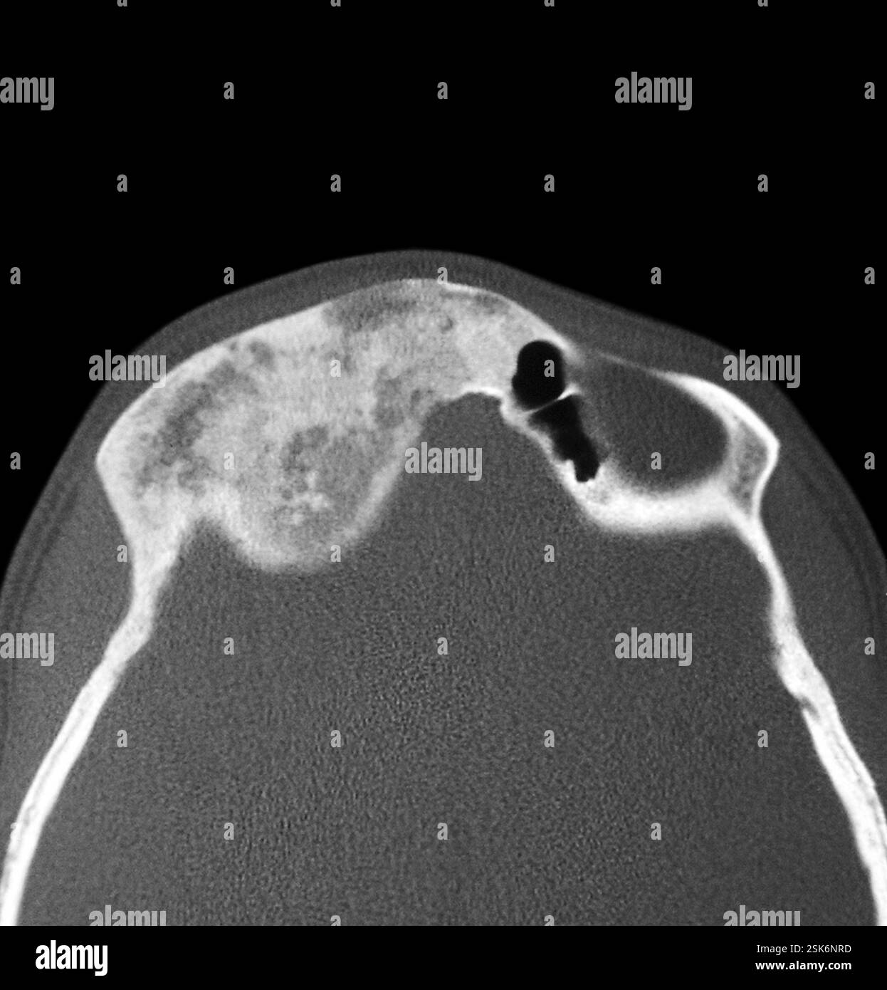Fibrous dysplasia of the skull, computed tomography (CT) scan. This is ...