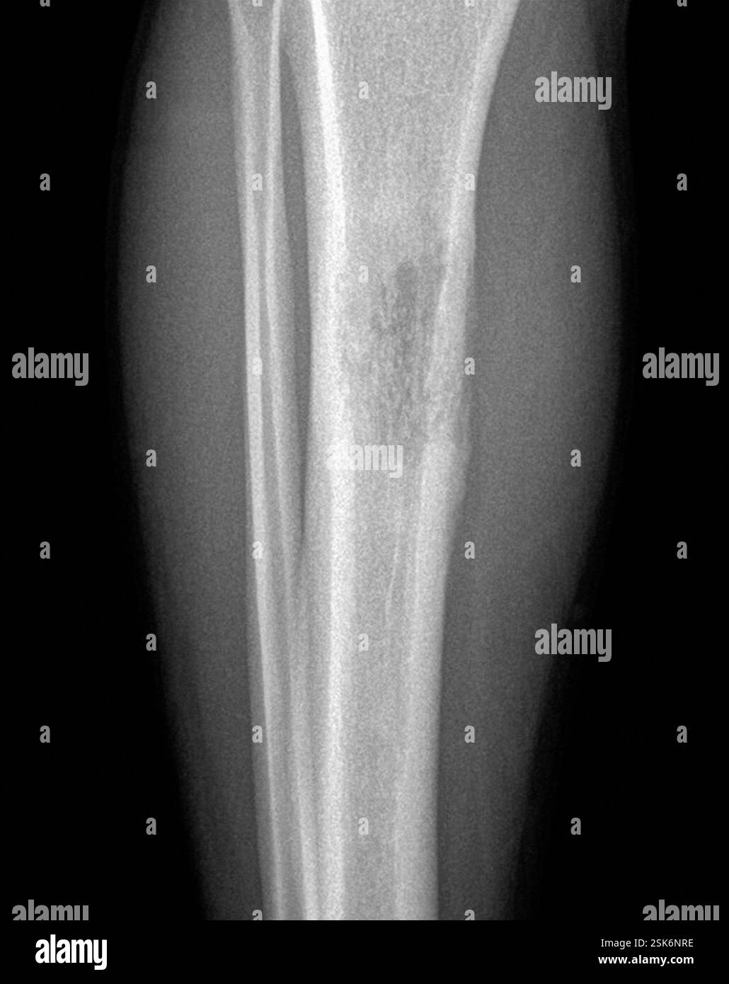 Frontal X-ray of the tibia (shin bone) of a patient with Ewing's ...