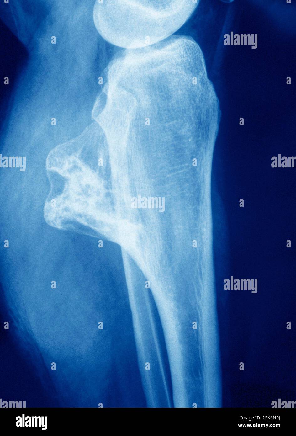 Bone tumour. Coloured lateral X-ray of the tibia (shin bone) of a ...