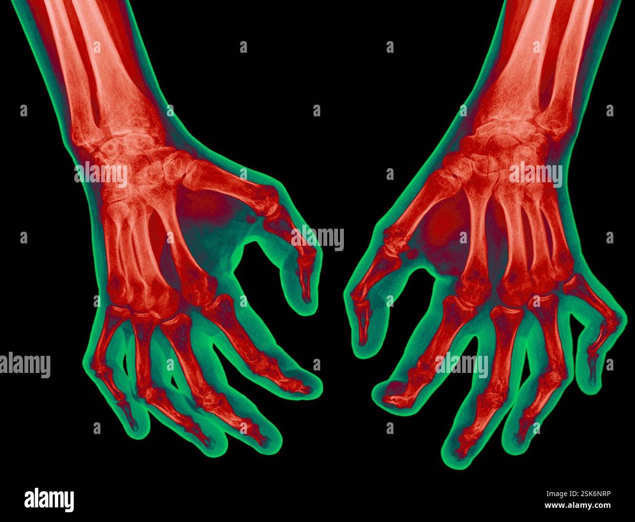 Coloured X-ray of the hands of a patient with rheumatoid arthritis. The ...