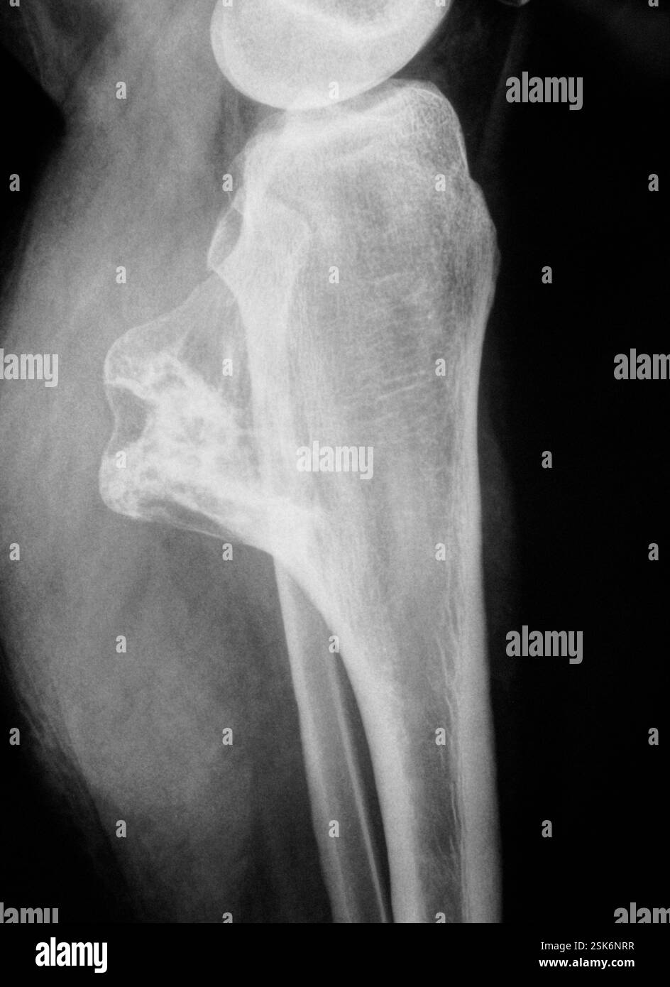 Bone tumour. Lateral X-ray of the tibia (shin bone) of a patient with ...