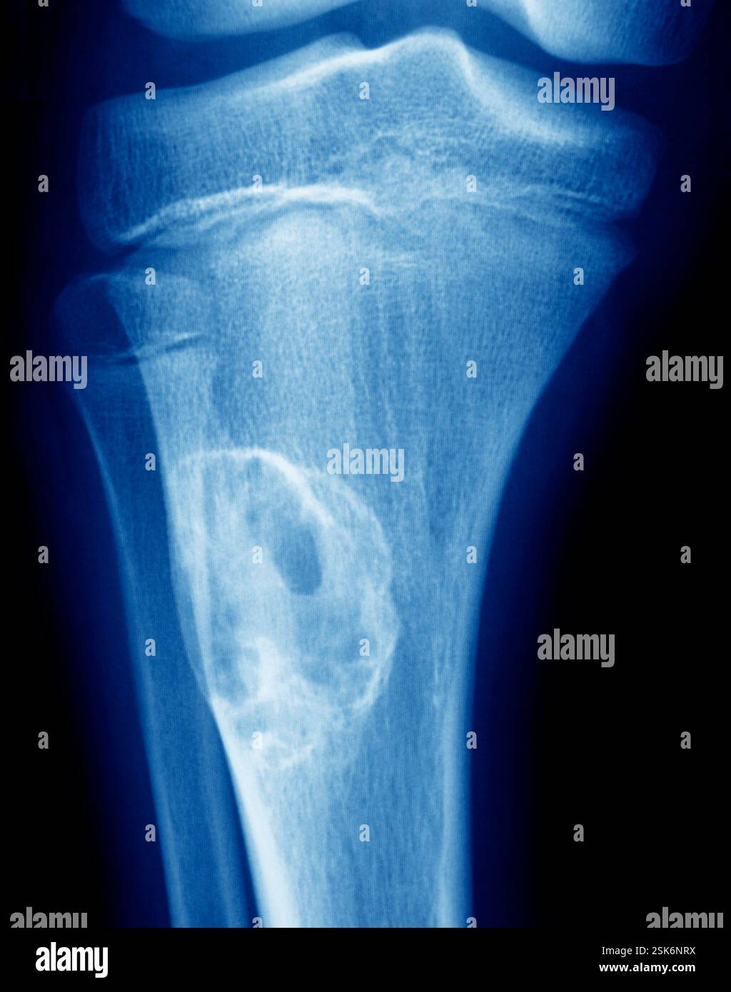 Bone tumour. Frontal X-ray of the knee of a patient with a non ...
