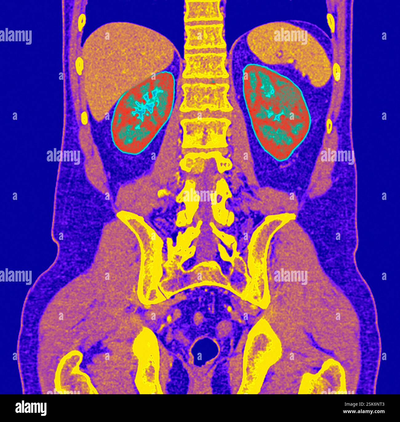 Healthy abdomen. Coloured frontal computed tomography (CT) scan of a ...