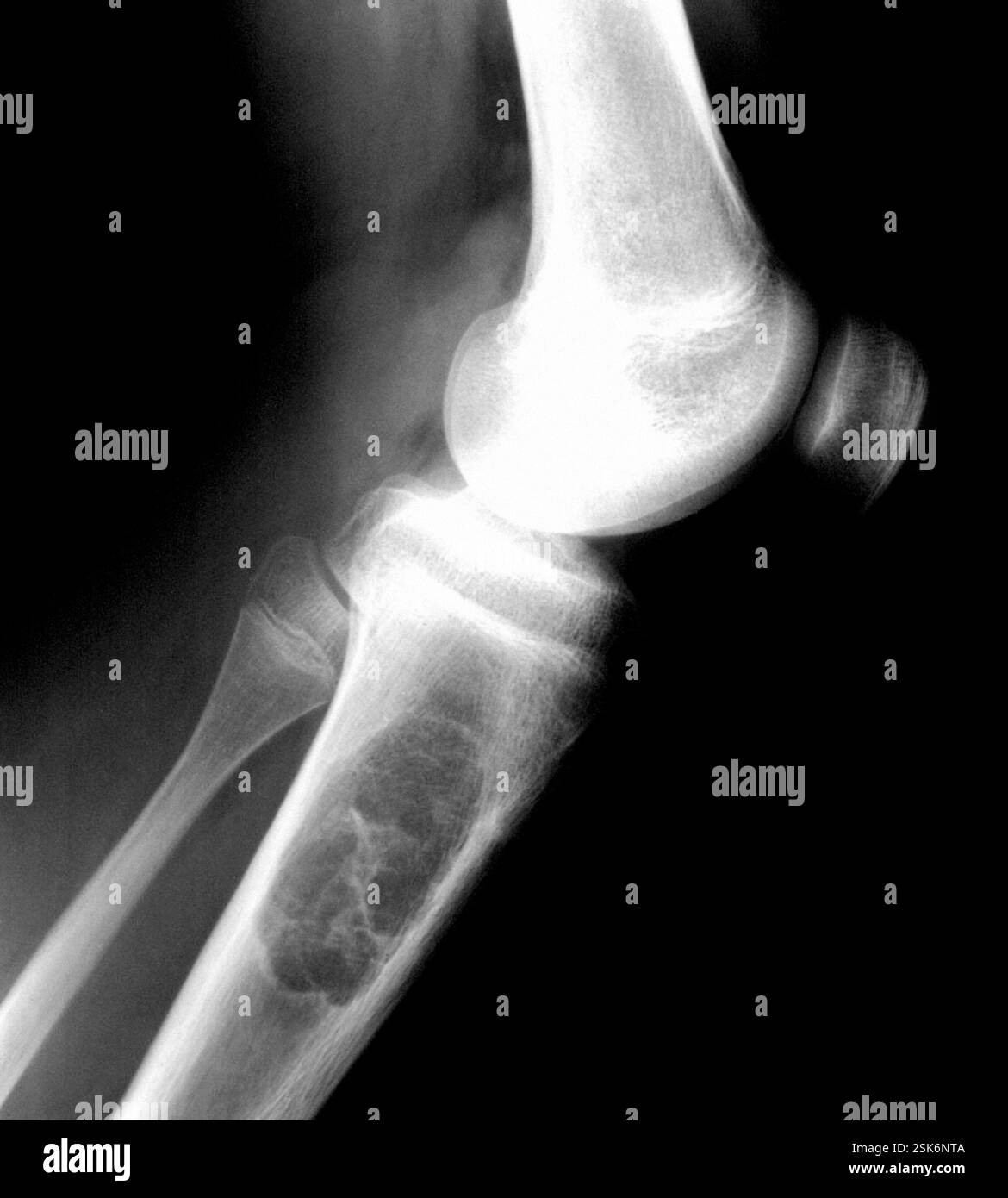 Bone tumour. Lateral X-ray of the knee of a patient with a non ...