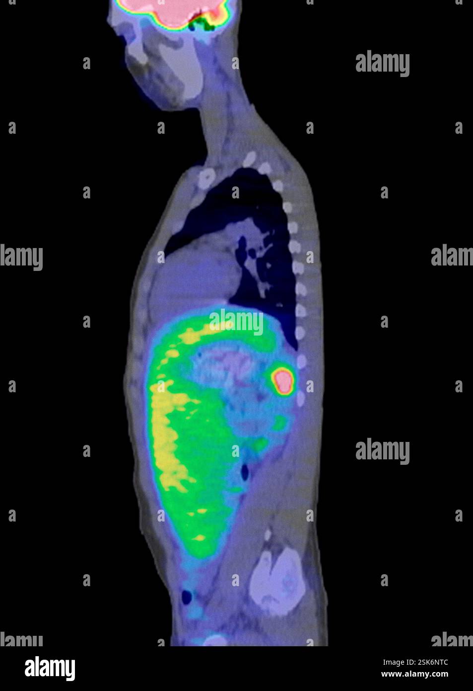 Splenomegaly. Composite image of a computed tomograpgy (CT) scan and a coloured positron ...