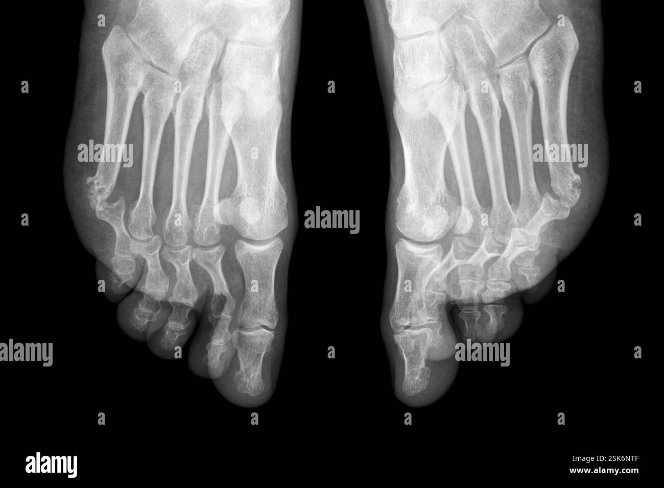 Arthritic feet. X-ray of the feet of a patient with rheumatoid ...