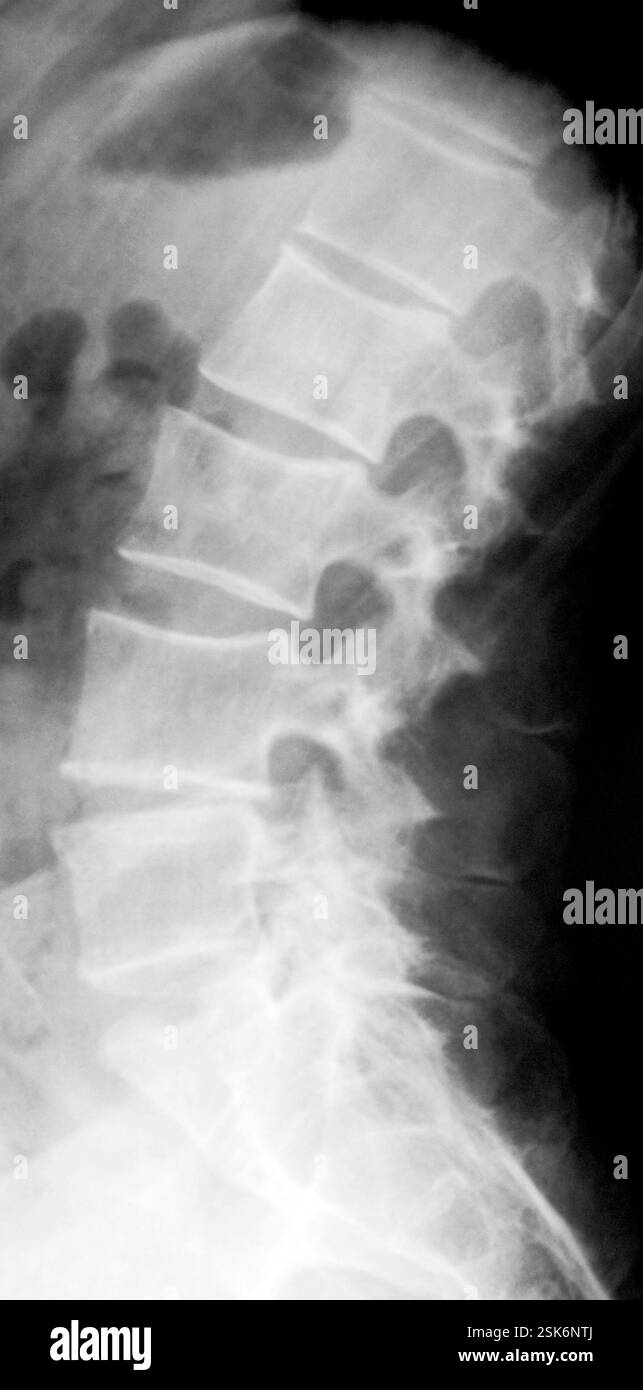 X-ray of a side view of the lumbar and sacral spine in ankylosing ...