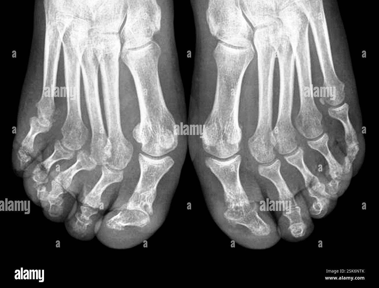X-ray image of human feet showing deformation due to rheumatoid ...