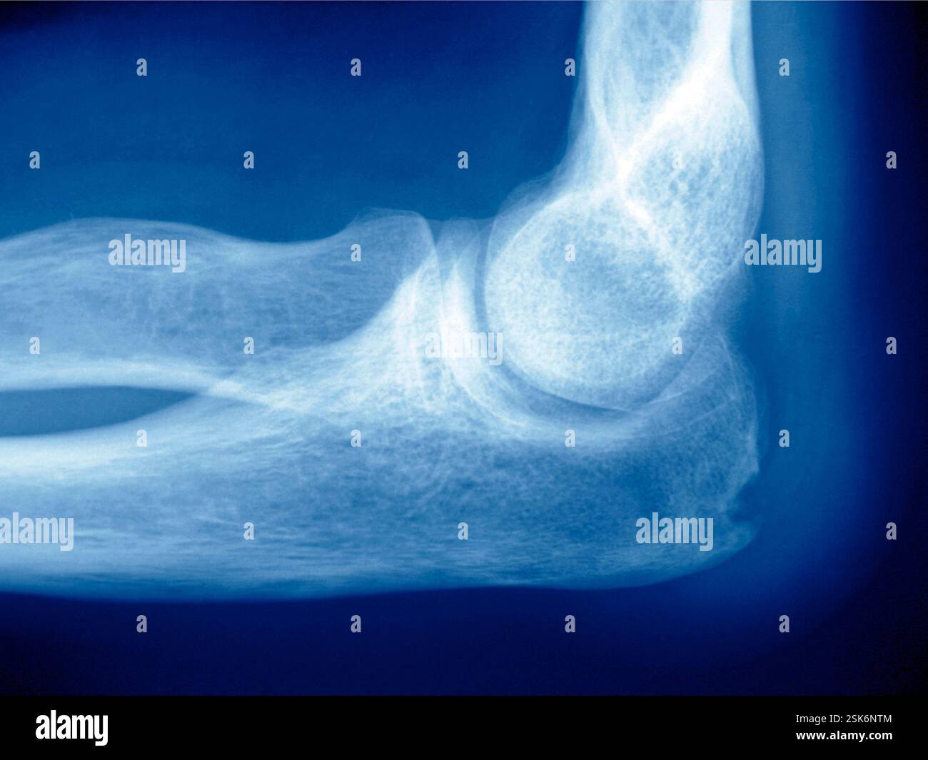 Coloured X-ray of the elbow of a patient with gout. Gout is a disorder ...
