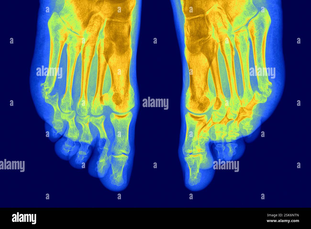 Arthritic feet. Coloured X-ray of the feet of a patient with rheumatoid ...