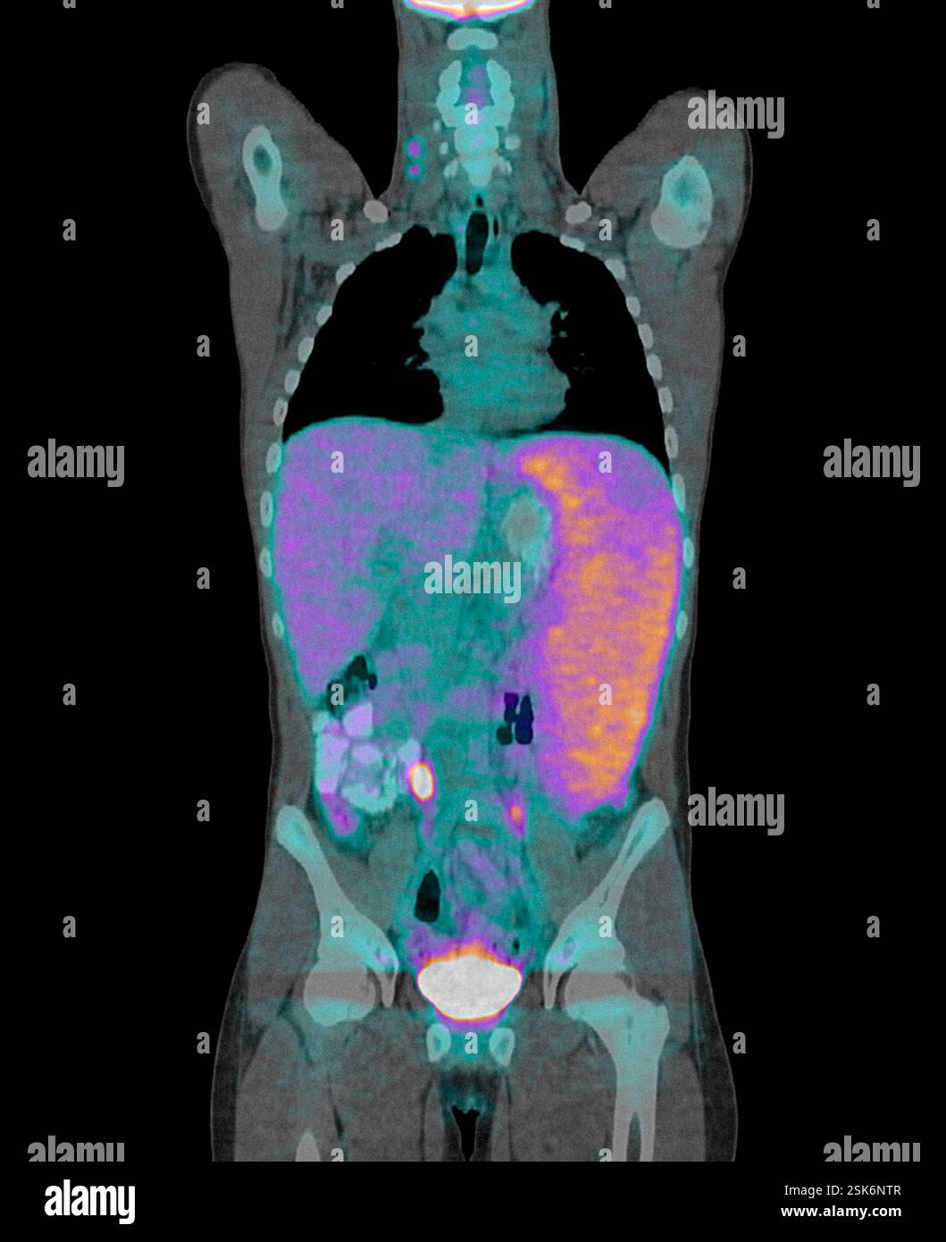 Splenomegaly. Composite image of a computed tomography (CT) scan and a ...
