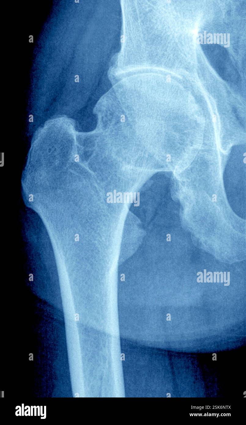 Coloured x-ray of the right hip of a patient with ankylosing ...