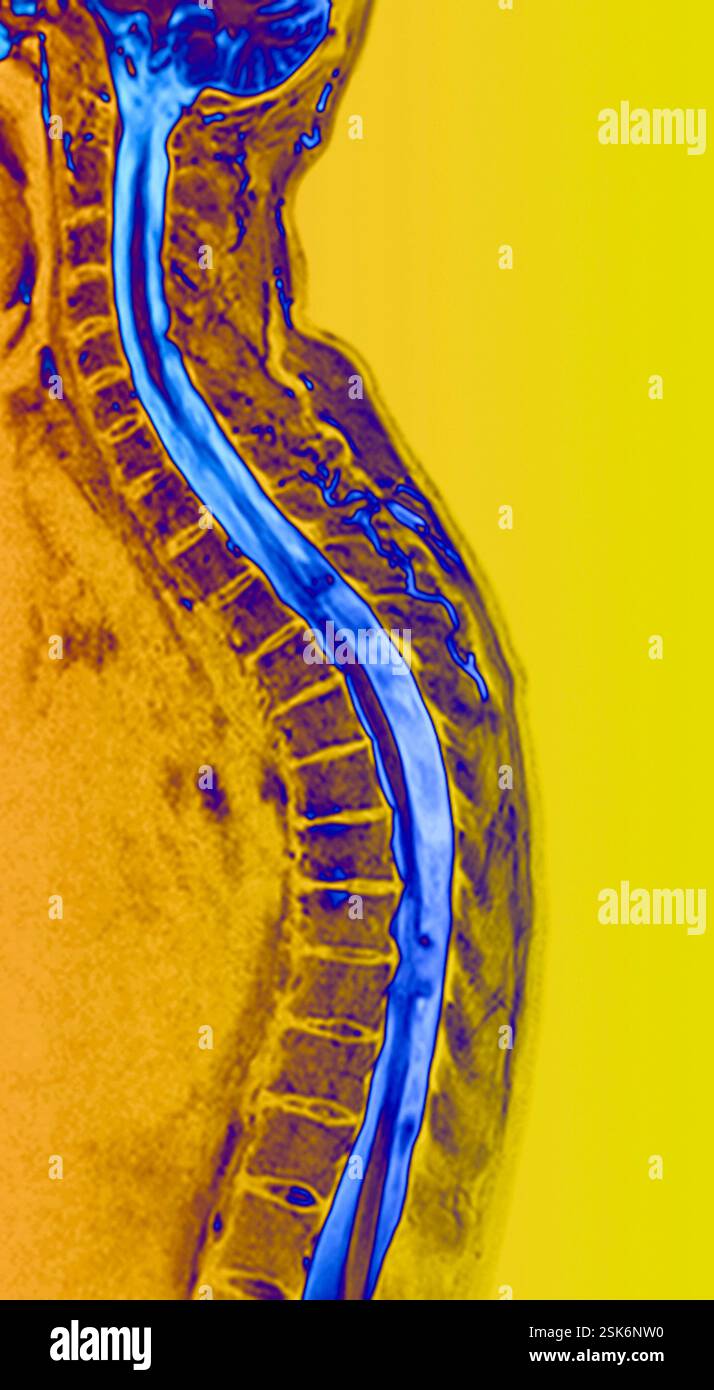 Side view Magnetic Resonance Image (MRI) of a patient with kyphosis ...