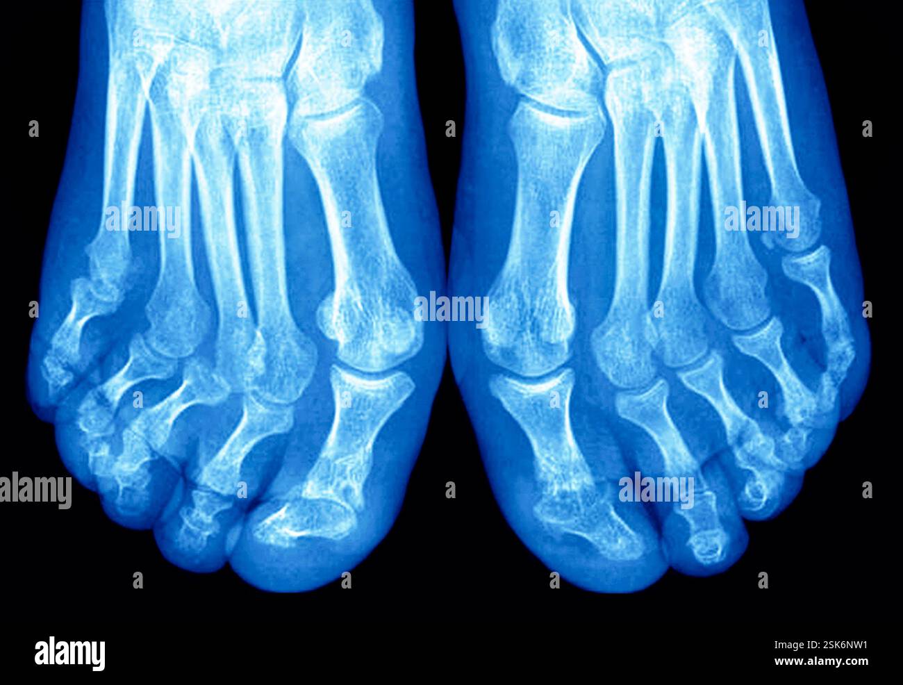 Coloured X-ray image of human feet showing deformation due to ...