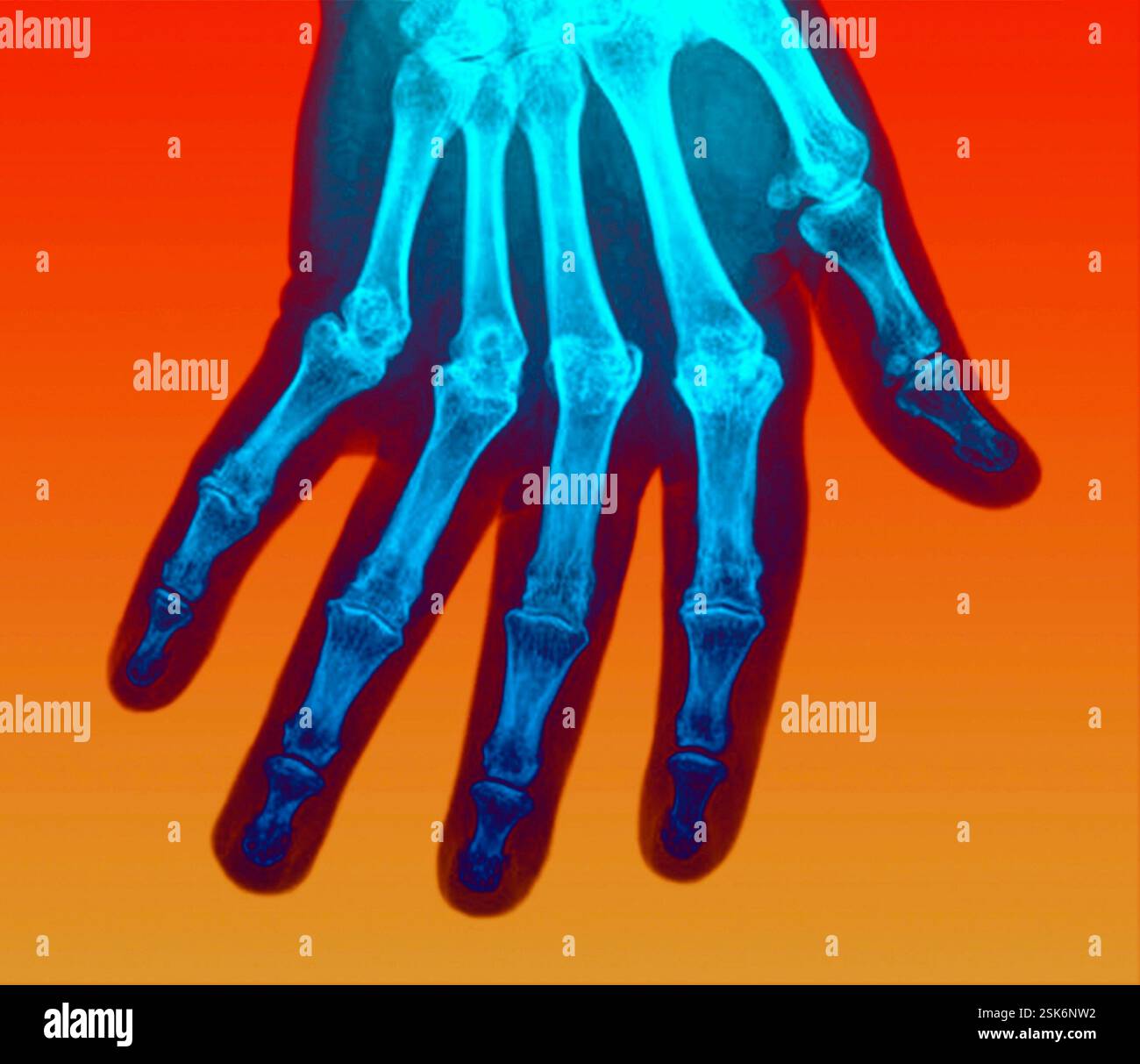 Coloured X-ray image of the human hand showing deformation due to ...