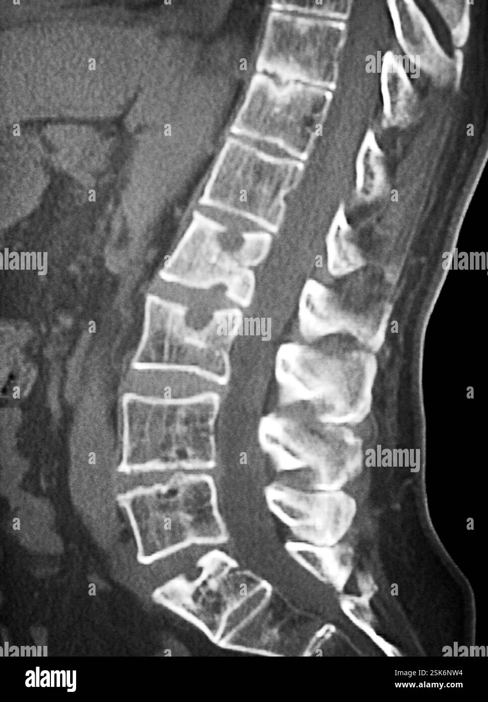 Computed tomography (CT) scan of a side view of the lumbar and sacral ...
