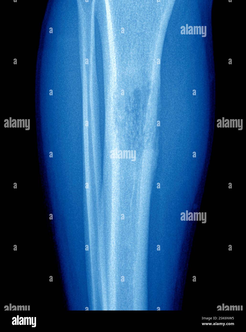 Coloured frontal X-ray of the tibia (shin bone) of a patient with Ewing ...