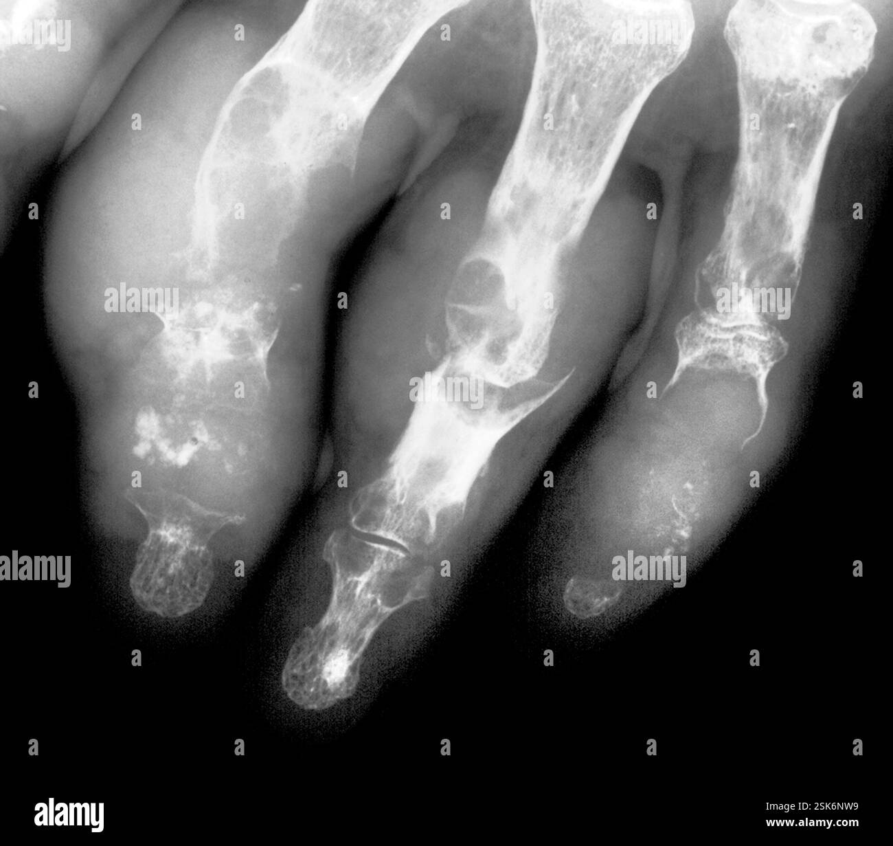 X-ray of the fingers of a patient with gout. Gout is a disorder of uric ...