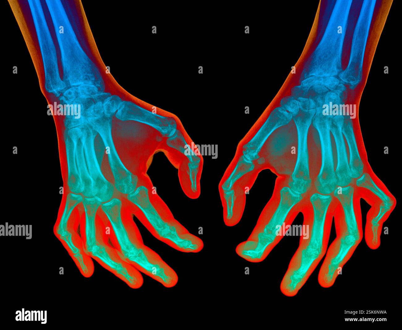 Coloured X-ray of the hands of a patient with rheumatoid arthritis. The ...