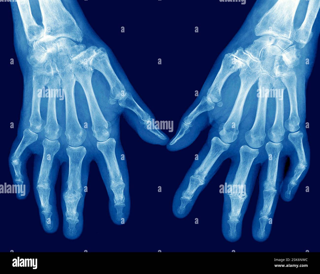 Coloured X-ray showing the hands of a patient with haemochromatosis ...