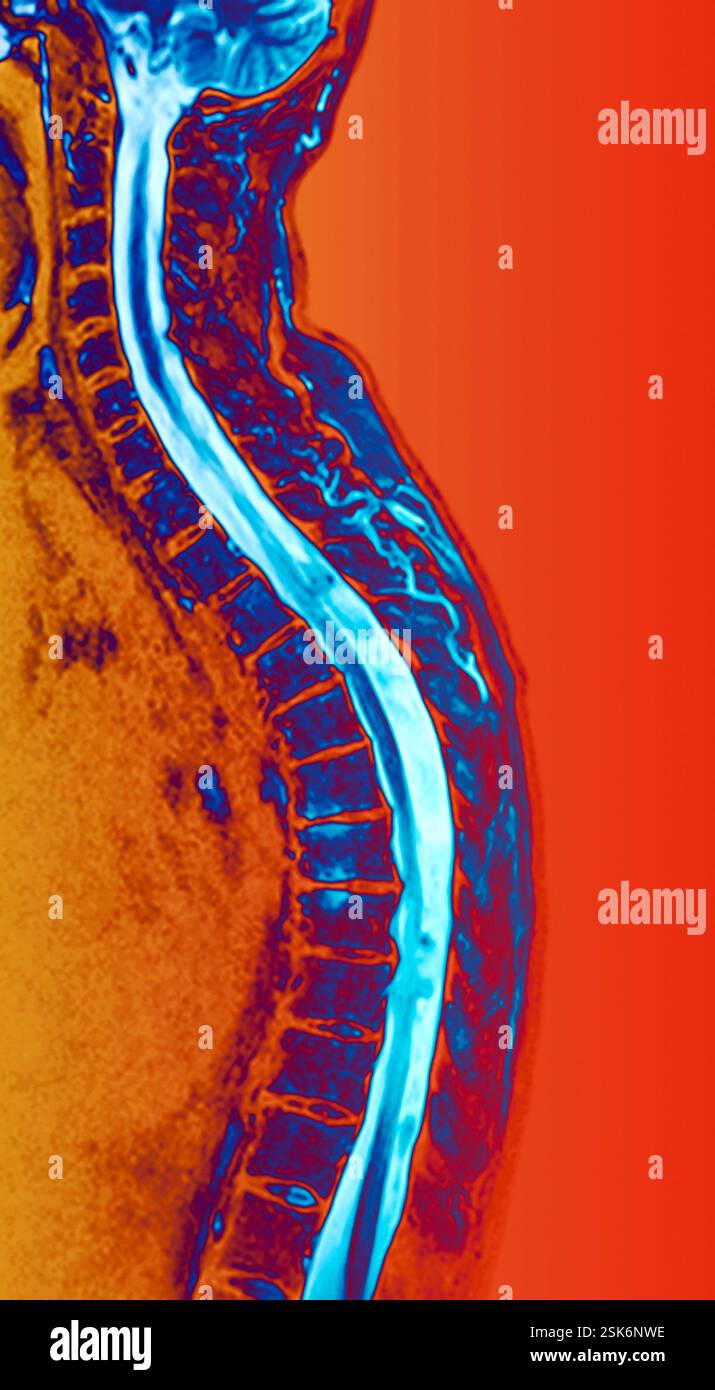 Side view Magnetic Resonance Image (MRI) of a patient with kyphosis ...