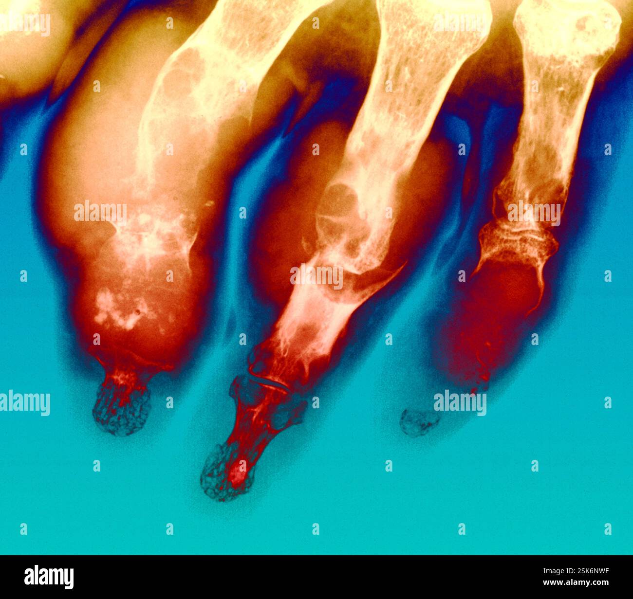 Coloured X-ray of the fingers of a patient with gout. Gout is a ...