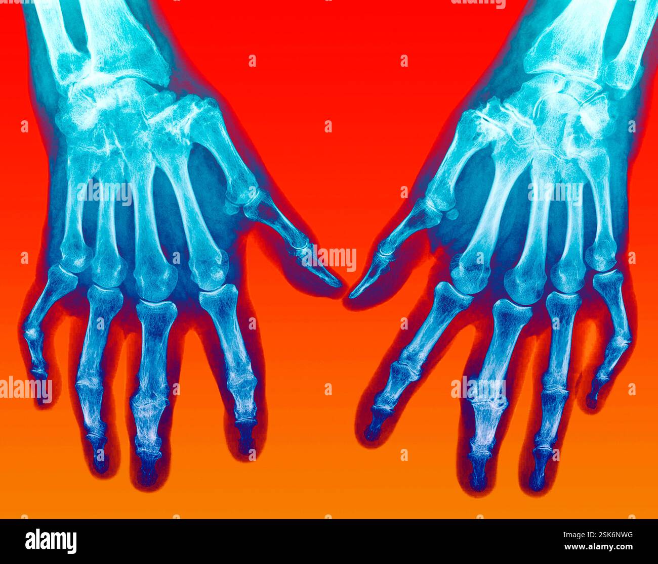 Coloured X-ray showing the hands of a patient with haemochromatosis ...