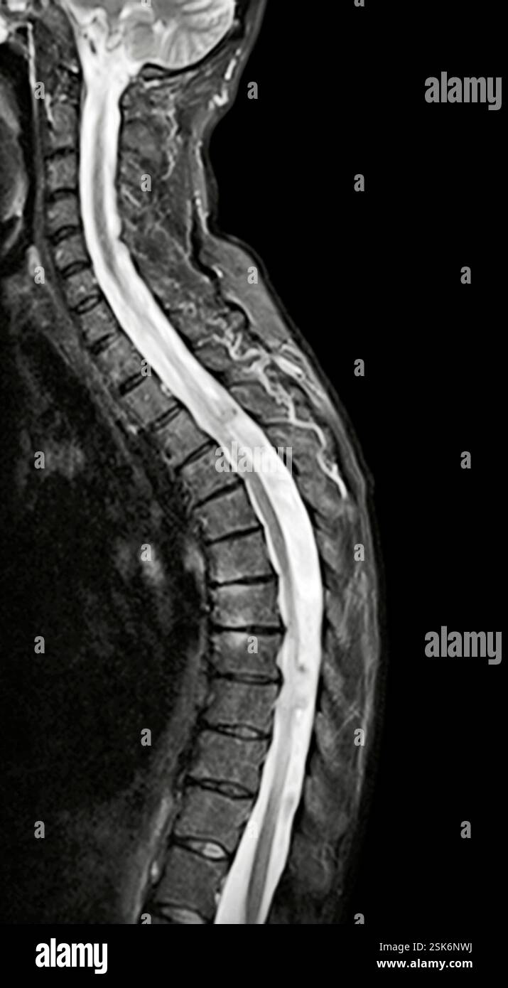 Side view Magnetic Resonance Image (MRI) of a patient with kyphosis ...
