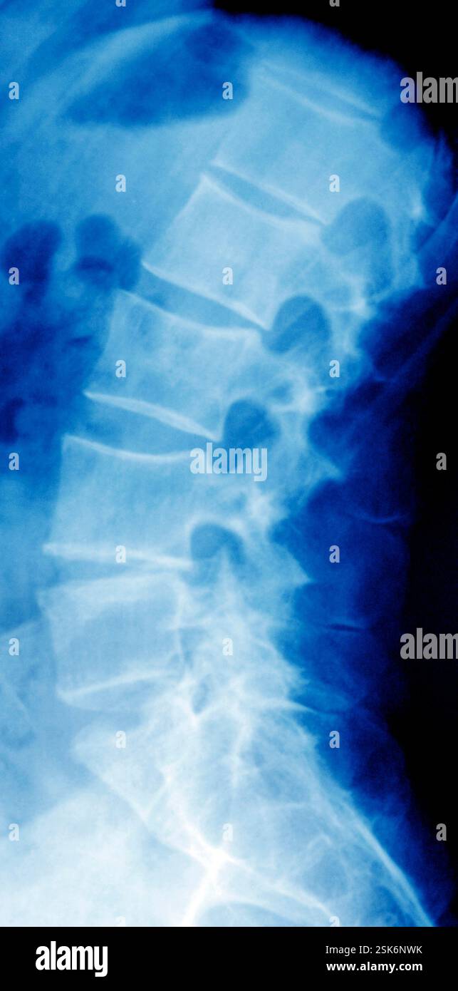 Coloured X-ray of a side view of the lumbar and sacral spine in ...