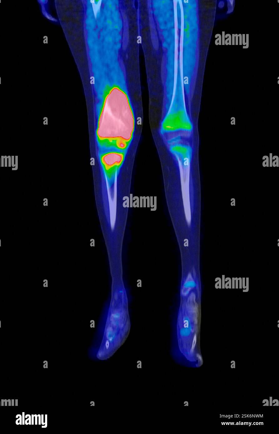 Bone cancer. Coloured positron emission tomography (PET) scan of the ...