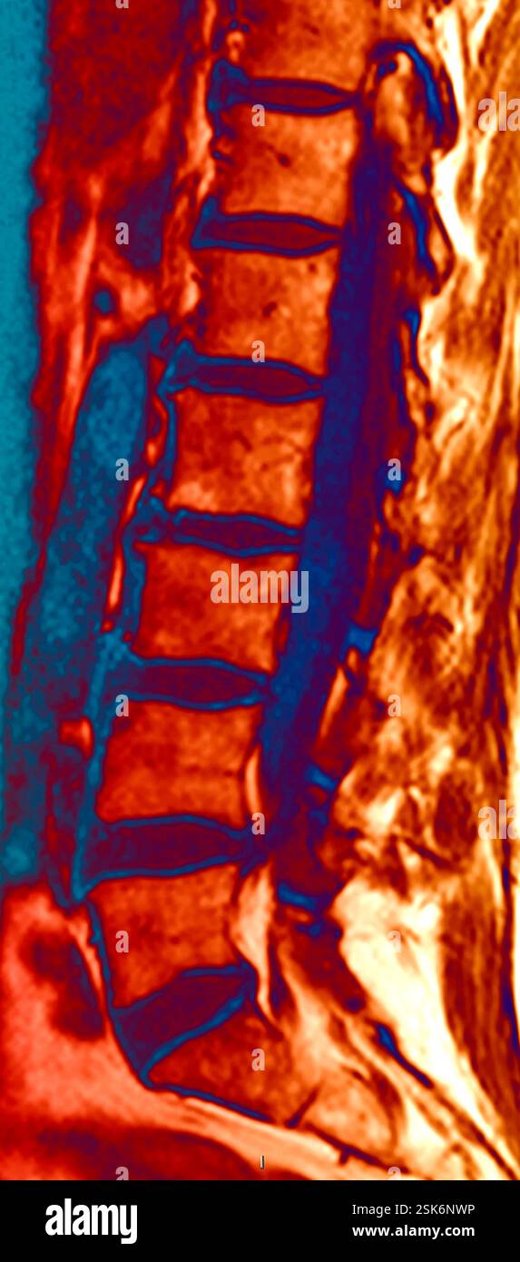 Coloured Magnetic Resonance Image (MRI) of the lumbar spine of a ...