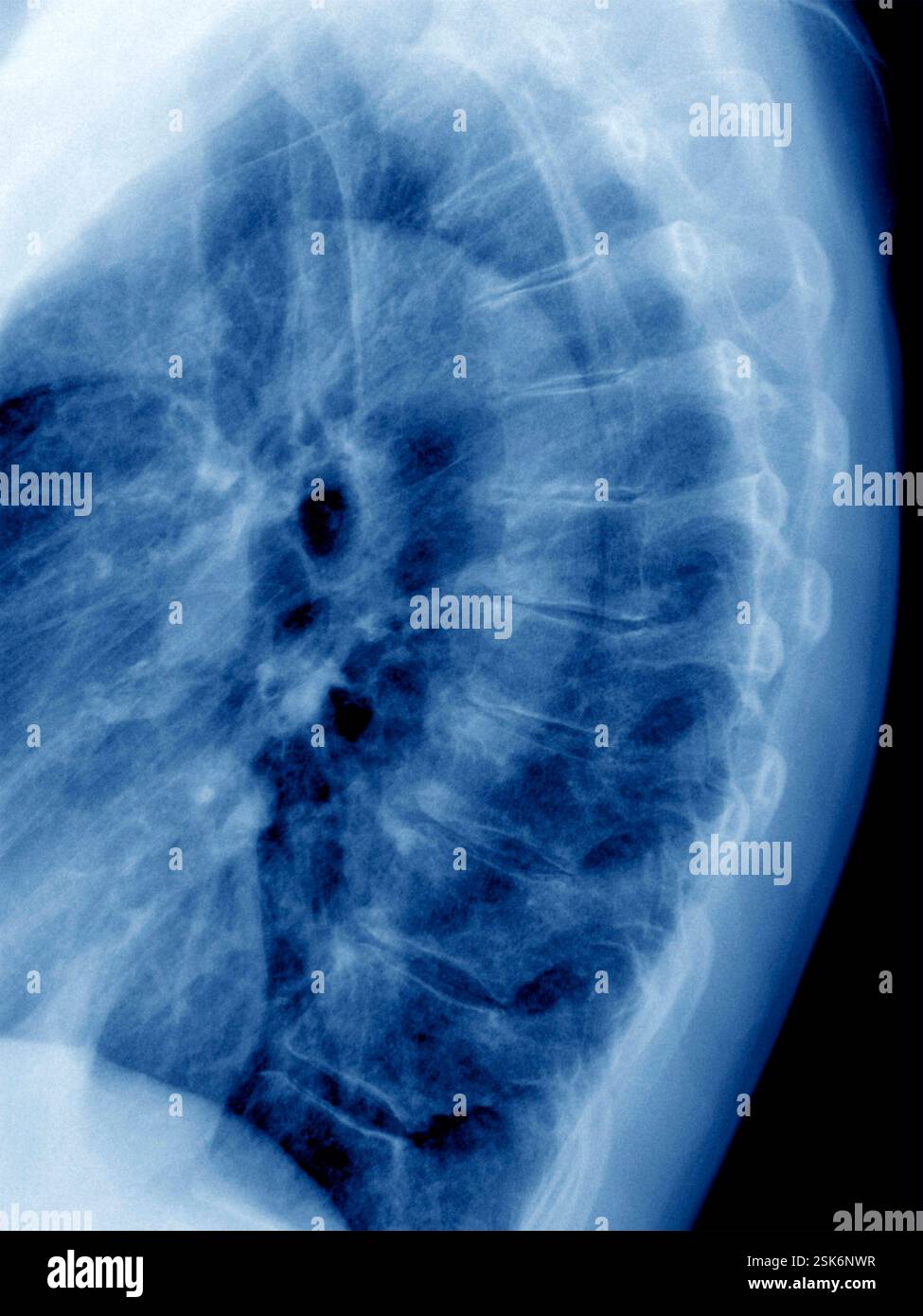 Coloured X-ray of a patient with kyphosis (curvature of the spine) in ...