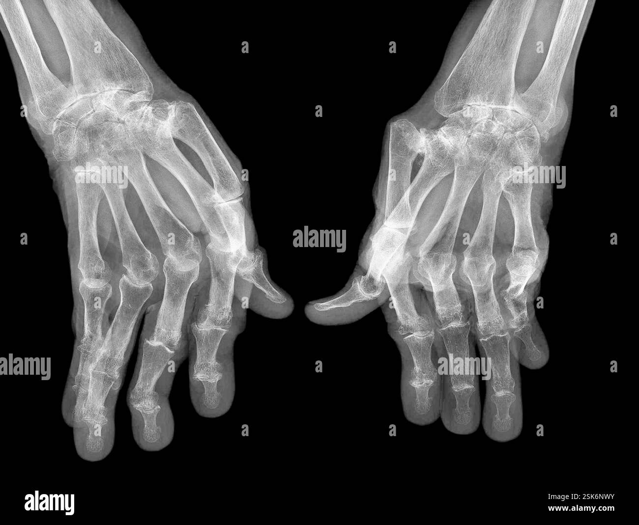 X-ray image of human hands showing deformation due to rheumatoid ...