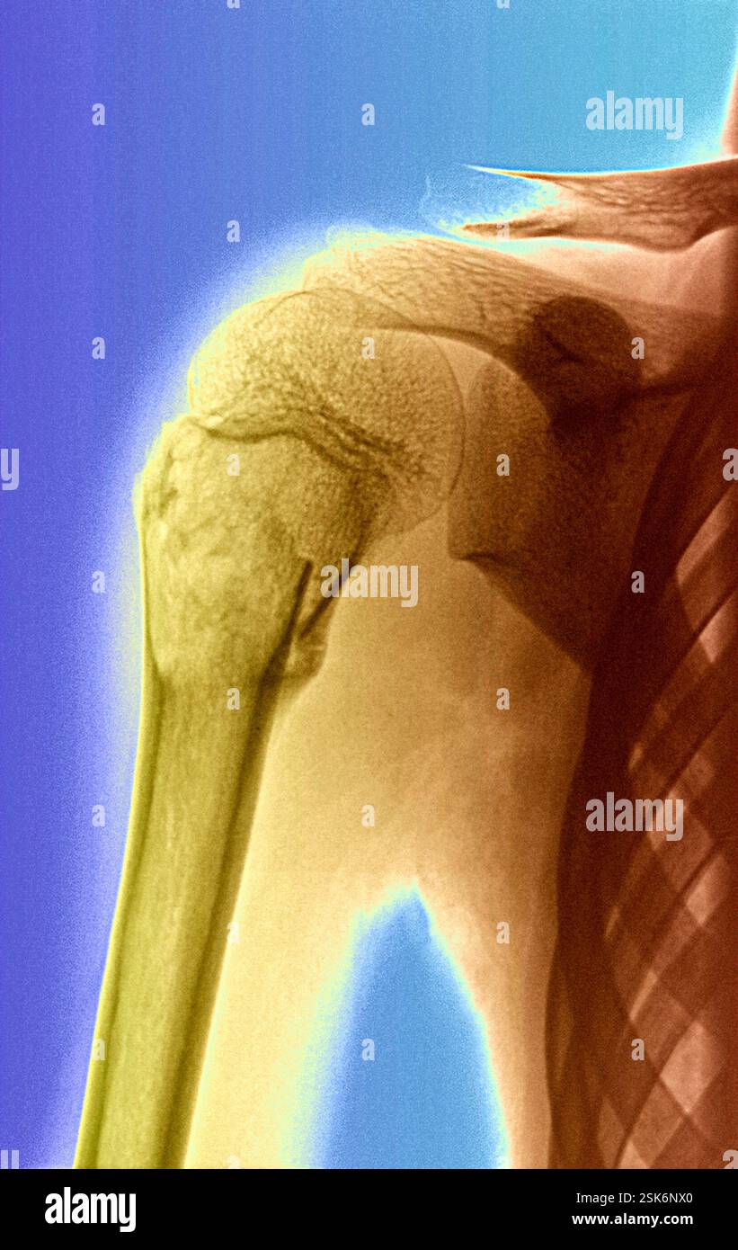Bone cyst and fracture. Coloured X-ray of the shoulder of a 12-year-old ...
