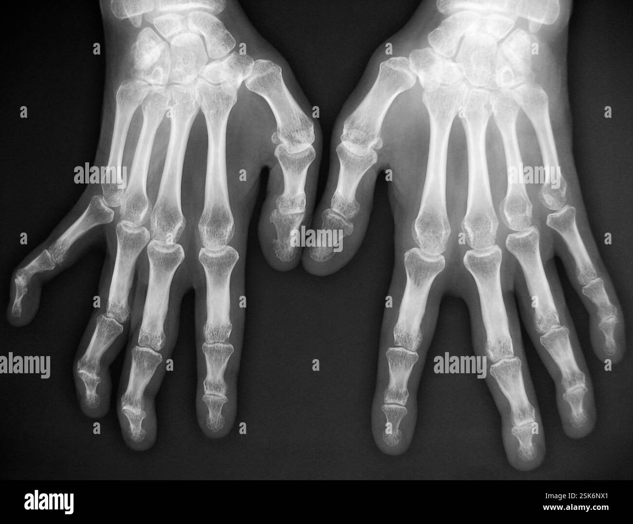 Systemic lupus erythematosus (SLE), X-ray. SLE is an autoimmune ...