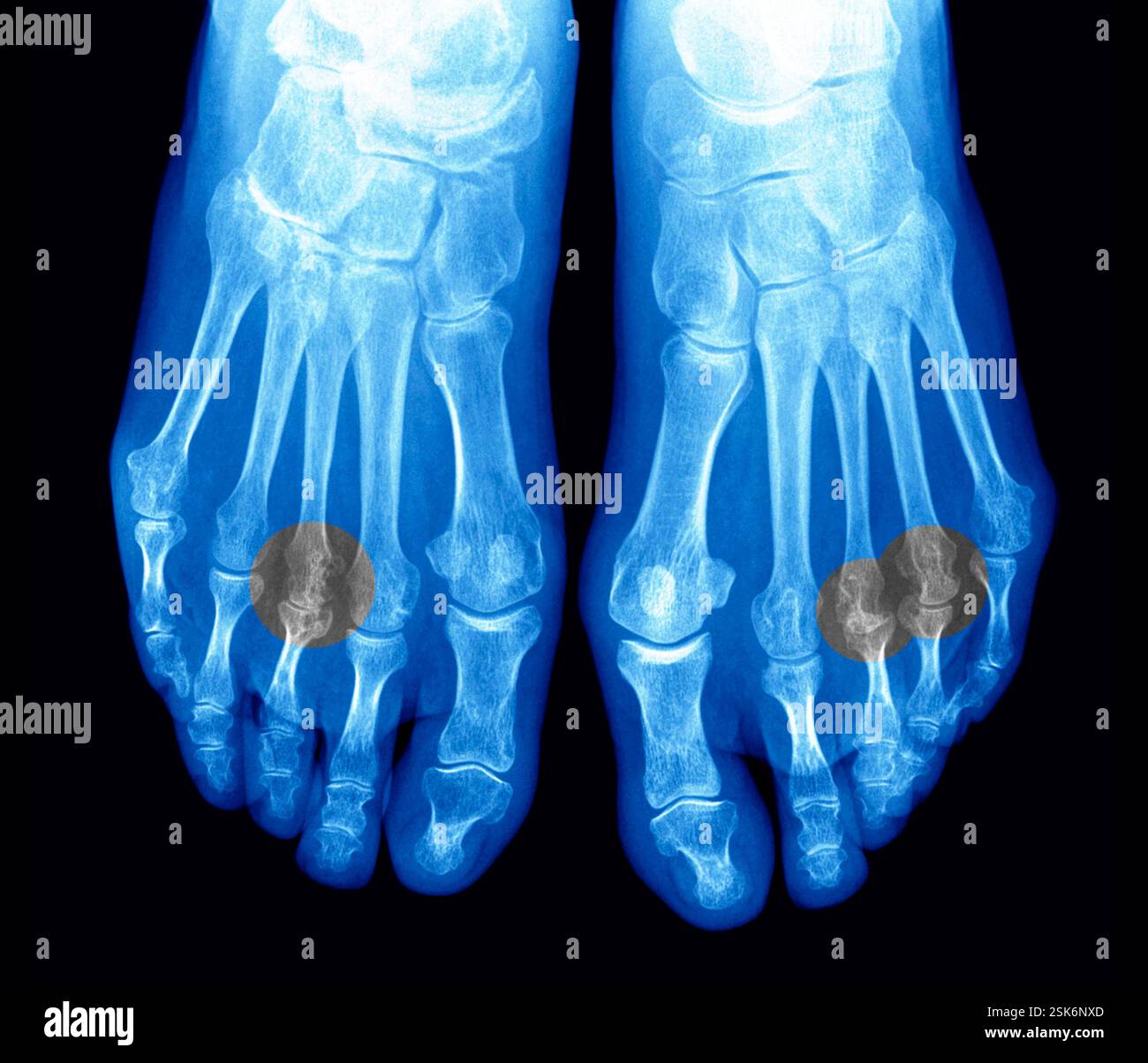 Coloured X-ray of the feet of a patient with rheumatoid arthritis ...