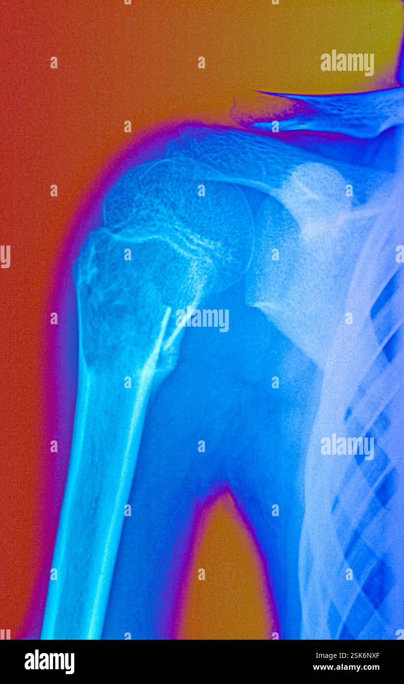 Bone cyst and fracture. Coloured X-ray of the shoulder of a 12-year-old ...