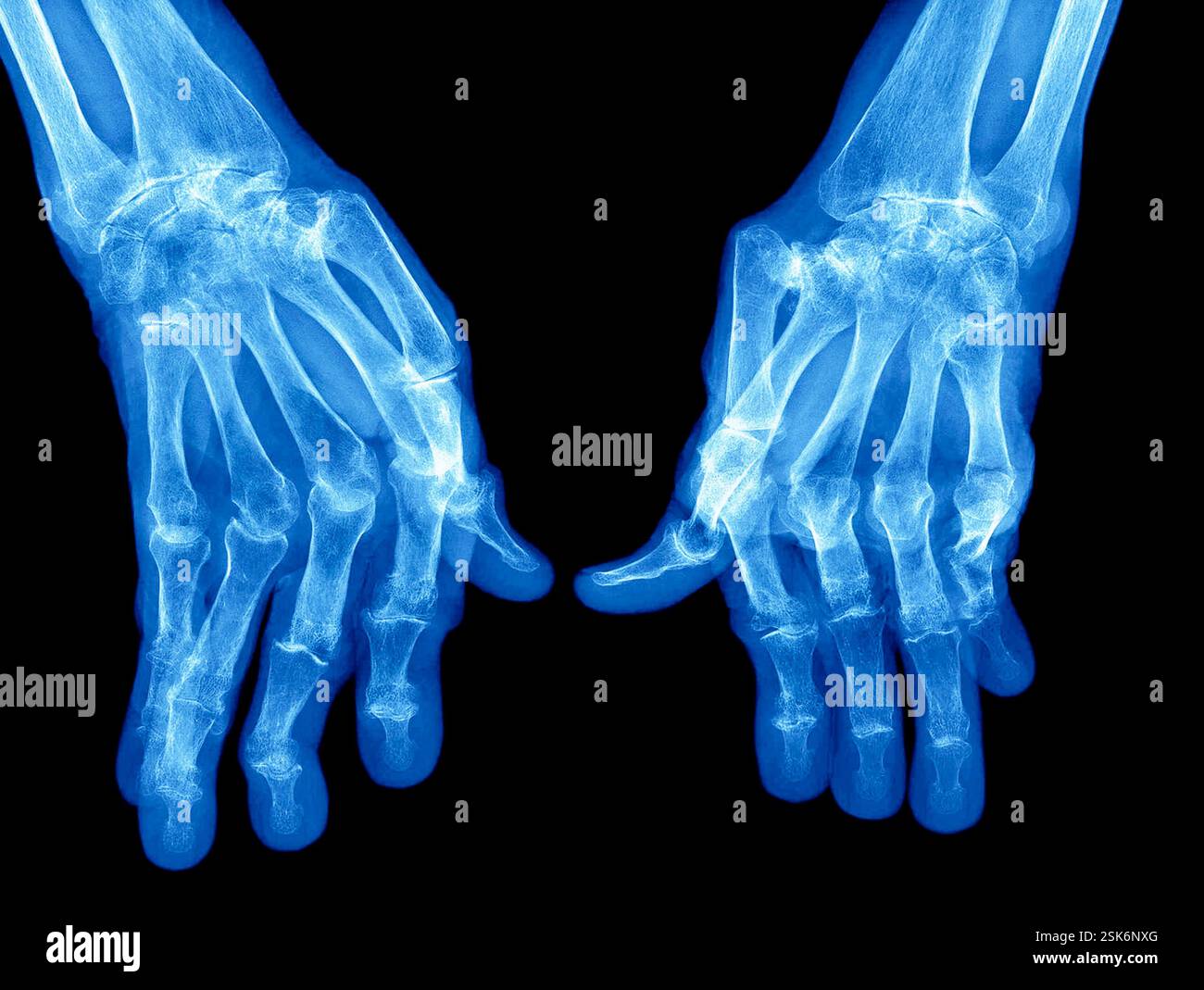 Coloured X-ray image of human hands showing deformation due to ...