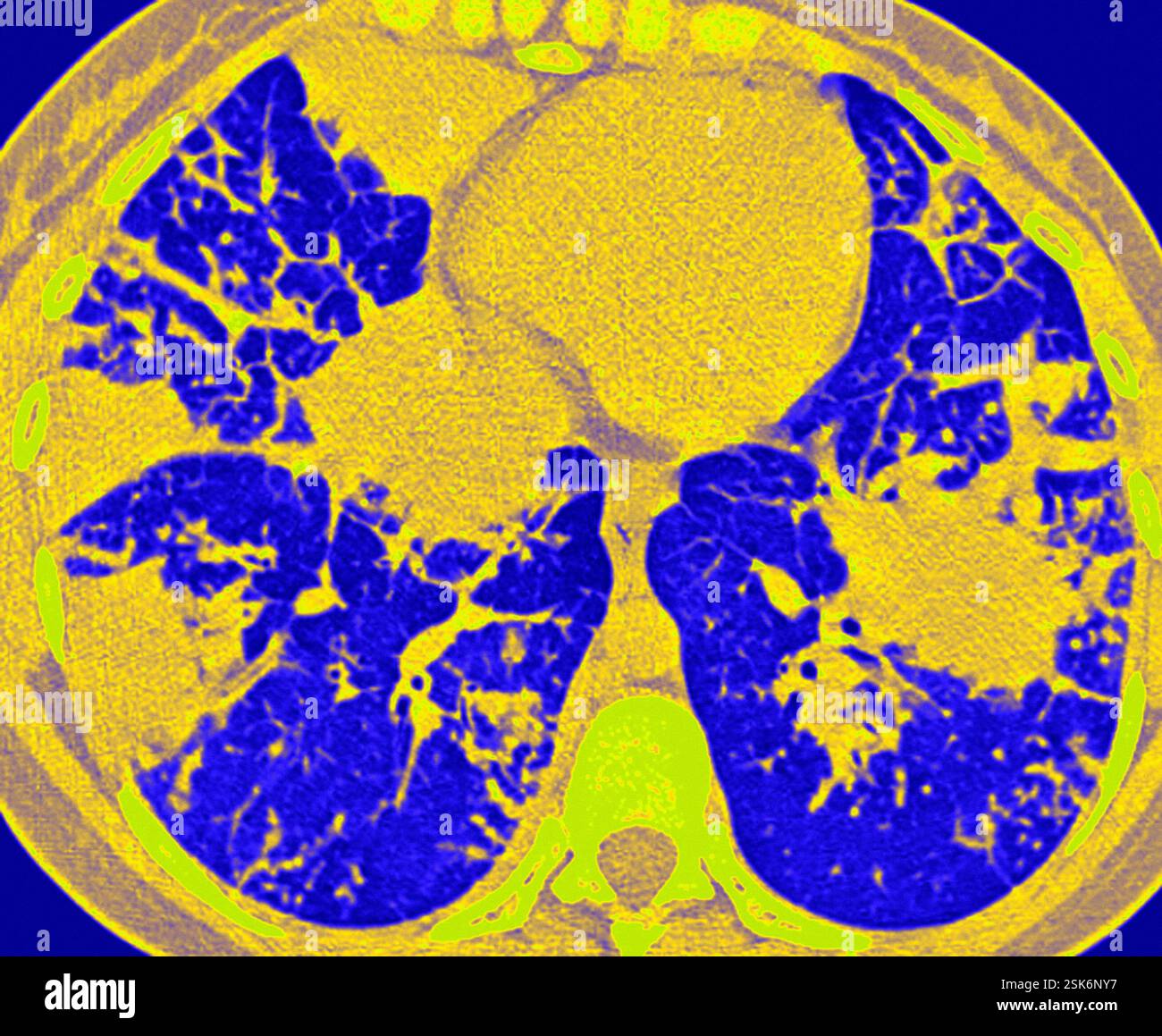 MALT lymphoma. Coloured computed tomography (CT) scan through the chest ...