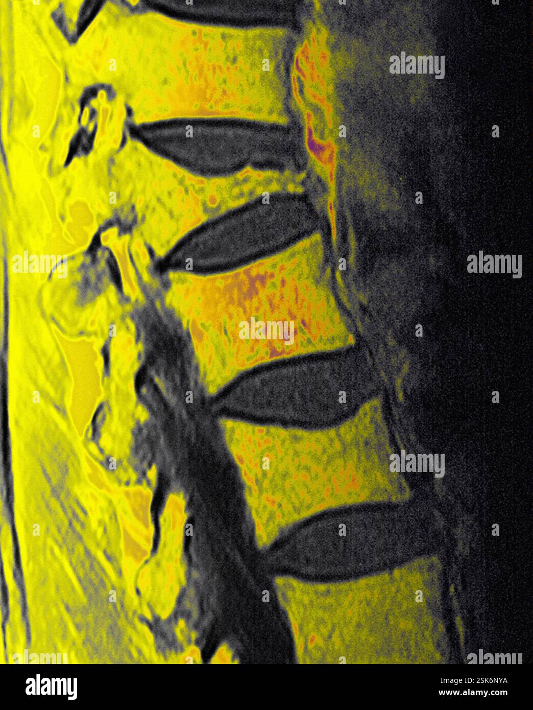 Osteoporosis of the spine. Coloured magnetic resonance image (MRI) of ...