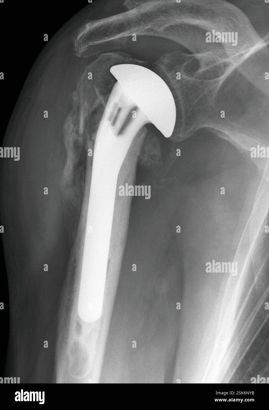 Artificial shoulder. X-ray of an artificial (prosthetic) right shoulder ...
