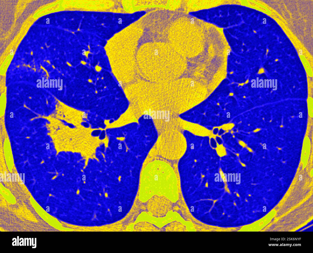 MALT lymphoma. Coloured computed tomography (CT) scan through the chest ...