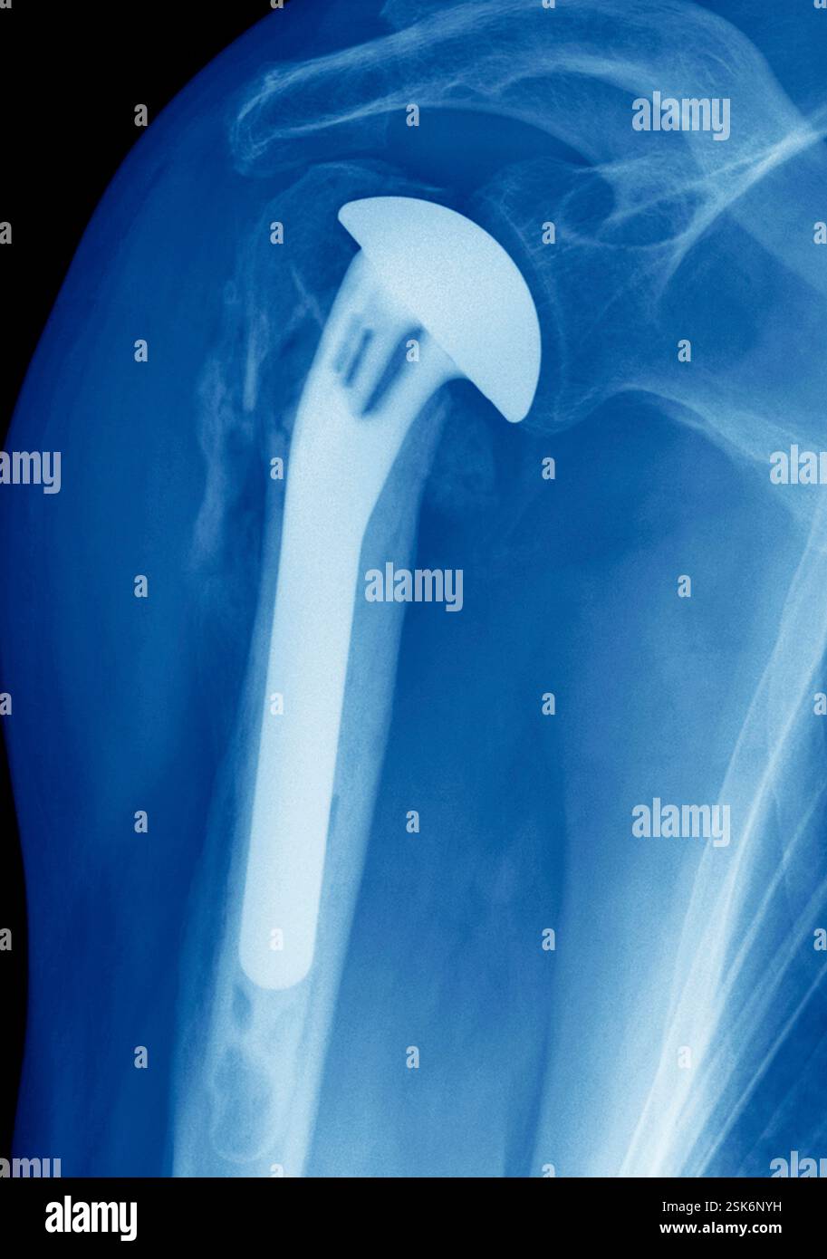Artificial shoulder. Coloured X-ray of an artificial (prosthetic) right ...