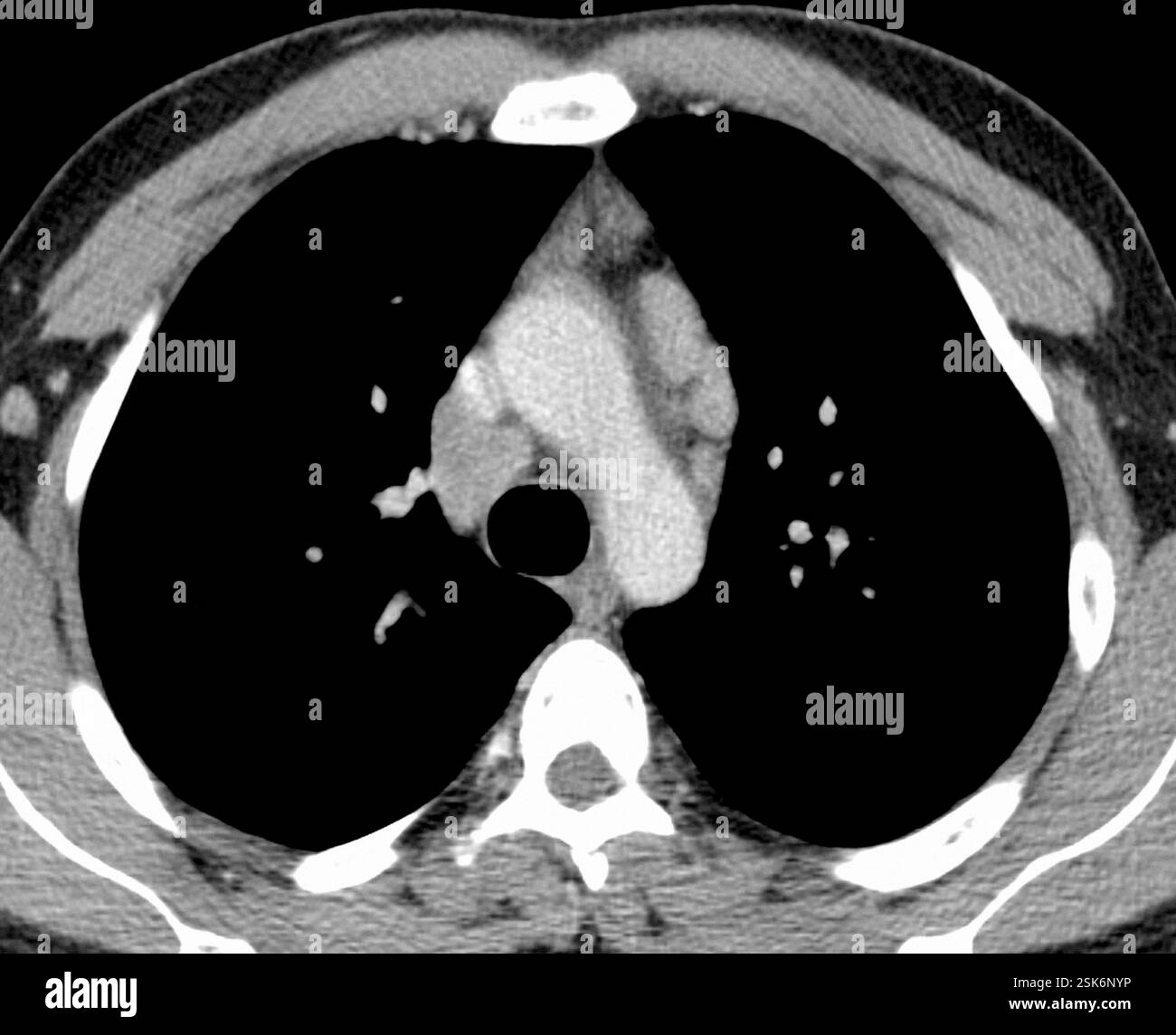 Hodgkin's lymphoma. Computed tomography (CT) scan showing enlarged ...