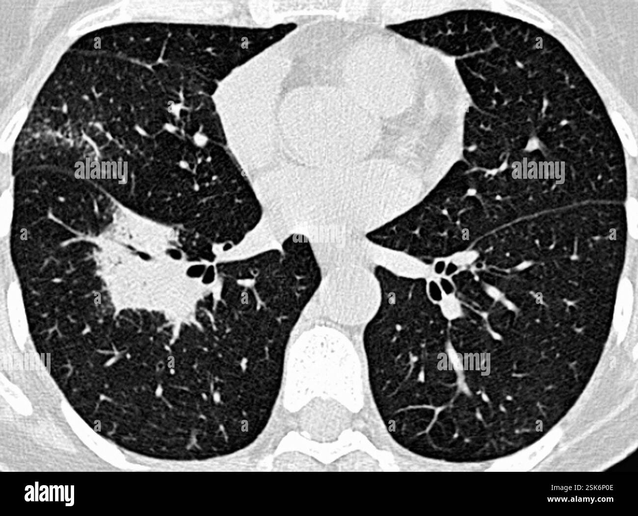 MALT lymphoma. Computed tomography (CT) scan through the chest of a 25 ...
