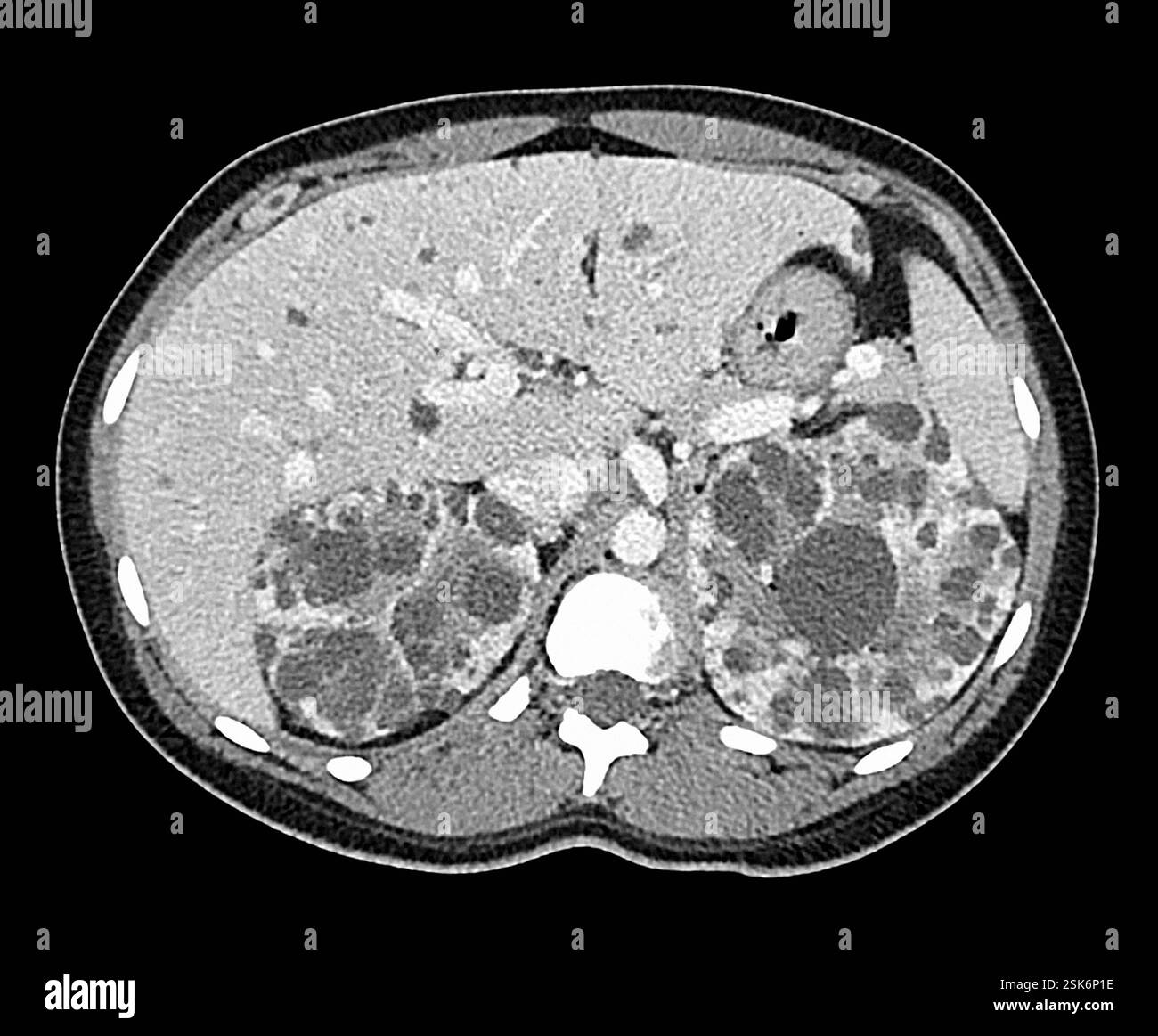 Polycystic kidneys. Computed tomography (CT) scan of the abdomen of a ...