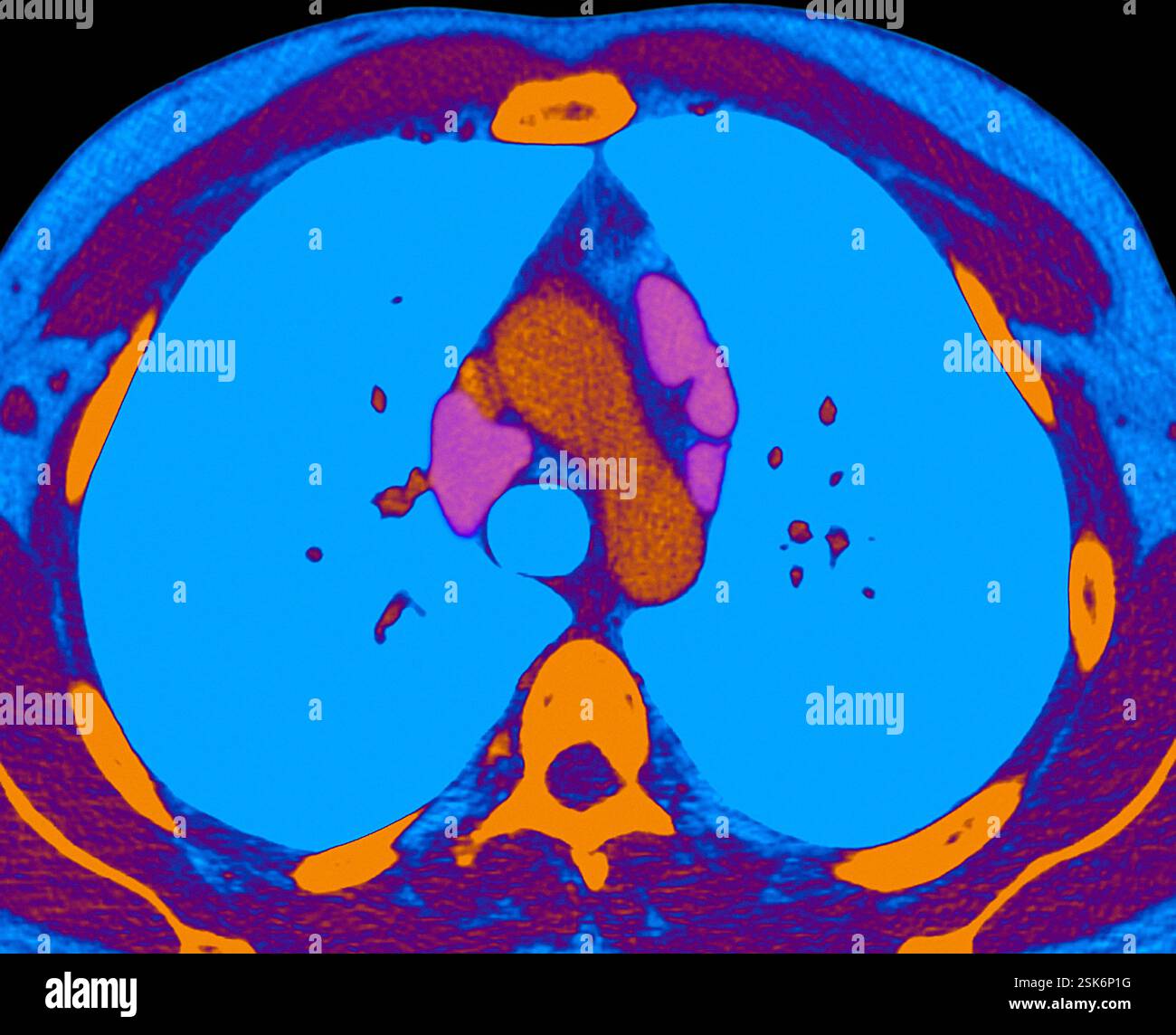 Mesothelioma lung tumour, CT scan Stock Photo - Alamy Mesothelioma lung tumour, CT scan Stock Photo - Alamy