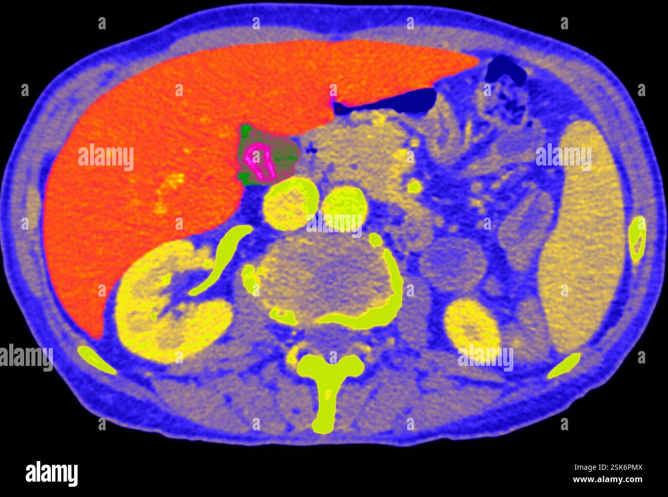 Gallstones. Coloured axial computed tomography (CT) scan of the abdomen ...
